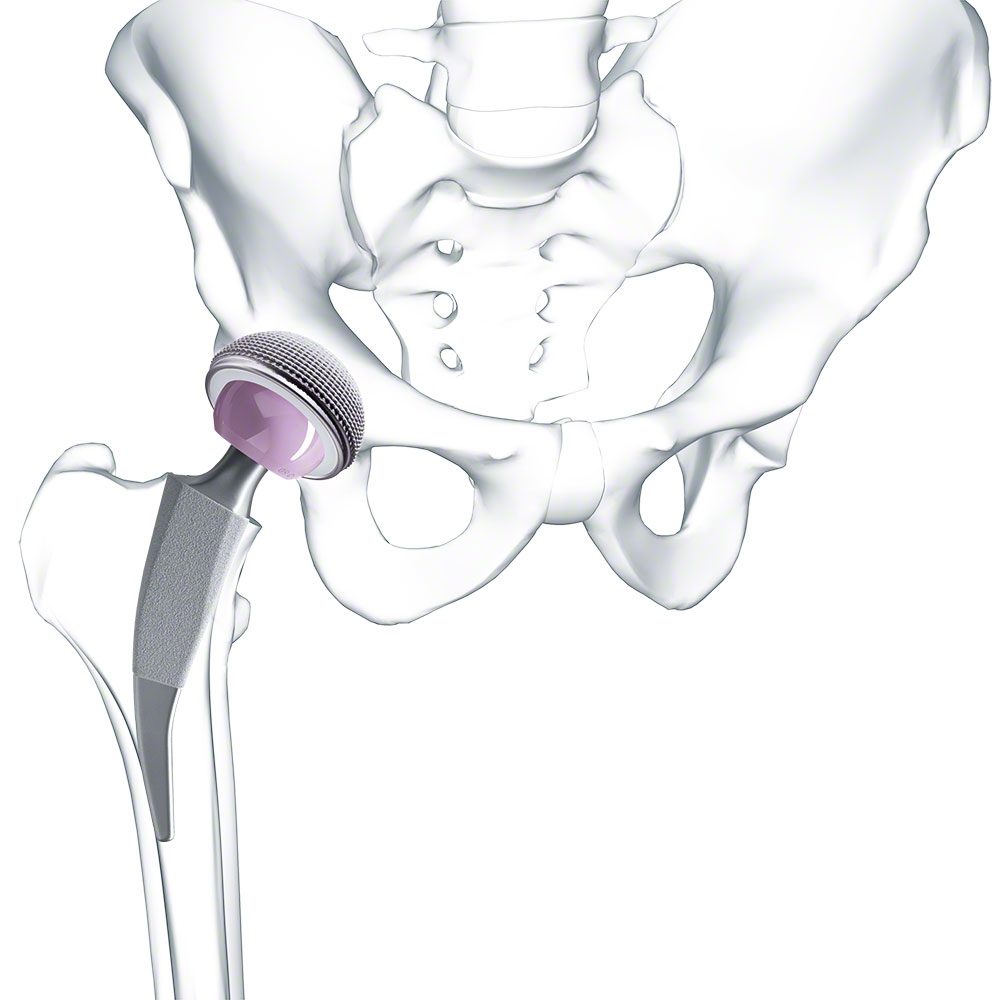 Metha® Short Hip Stem - PT Boswell Mahakarya Indonesia